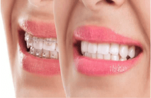 How do braces straighten teeth?