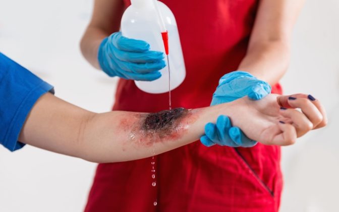 Determining The Cause of a Burn Damage