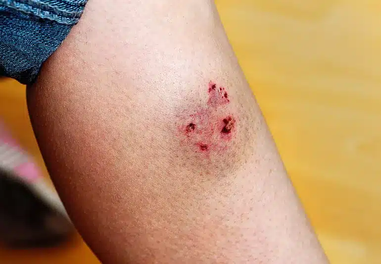 What Should You Do Immediately After a Dog Bite Injury?